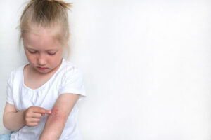 A Parent’s Guide to Allergies in Children | Redwood Pediatrics